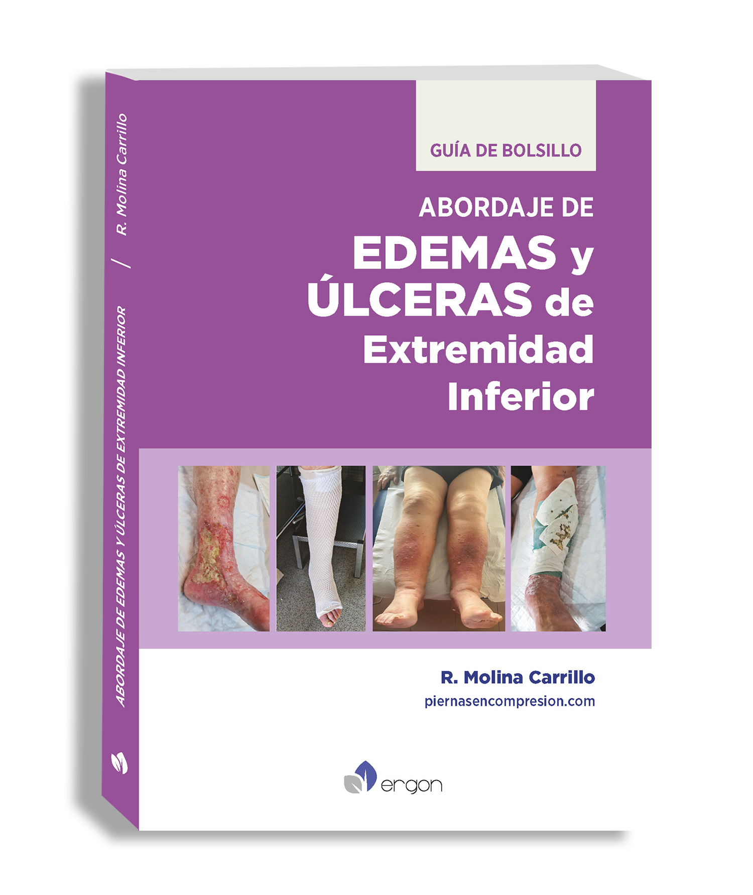 Abordaje de edemas y úlceras de extremidad inferior - Ergon